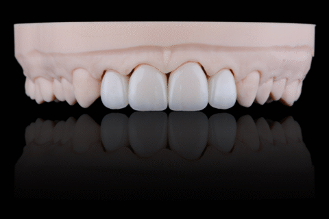 4 Front Teeth Bridge Explained by Dr. Alisha Khan | Expert Insights