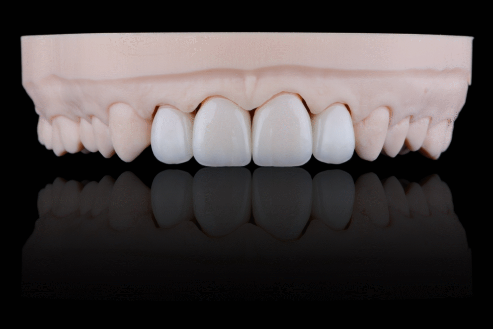 4 Front Teeth Bridge Explained by Dr. Alisha Khan | Expert Insights
