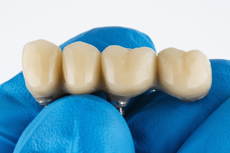 4 Front Teeth Bridge Explained by Dr. Alisha Khan | Expert Insights
