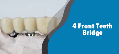 4 Front Teeth Bridge Explained by Dr. Alisha Khan | Expert Insights