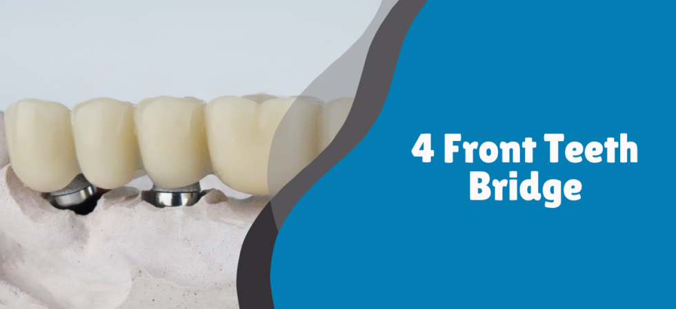 4 Front Teeth Bridge Explained by Dr. Alisha Khan | Expert Insights