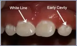 Dental Fillings in Chembur: Early Signs of Cavities You Should Never ...